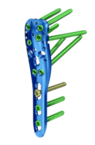 PHILOS – Proximal Humerus Internal Locking System - ACJ
