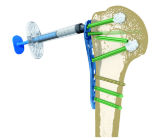 PHILOS – Proximal Humerus Internal Locking System - ACJ