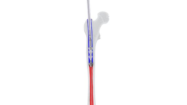 RIA – Reamer/Irrigator/Aspirator System - ACJ