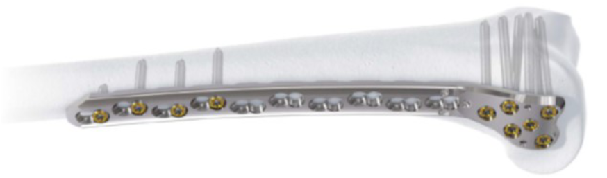 VA Condylar Plate – Variable Angle Locking Condylar Plate System - ACJ