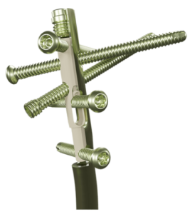 Clavo Tibial – Sistema de enclavado intramedular para tibia - ACJ