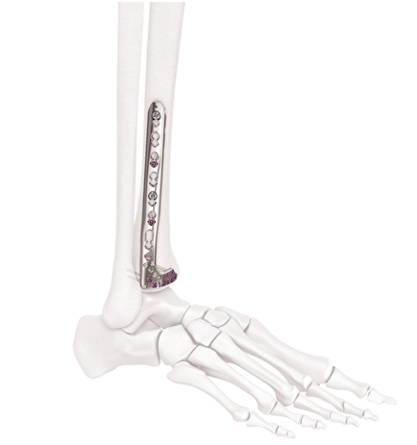 Sistema de osteosíntesis para fracturas maleolares y del tobillo - ACJ
