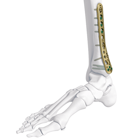 Sistema de osteosíntesis para fracturas maleolares y del tobillo - ACJ